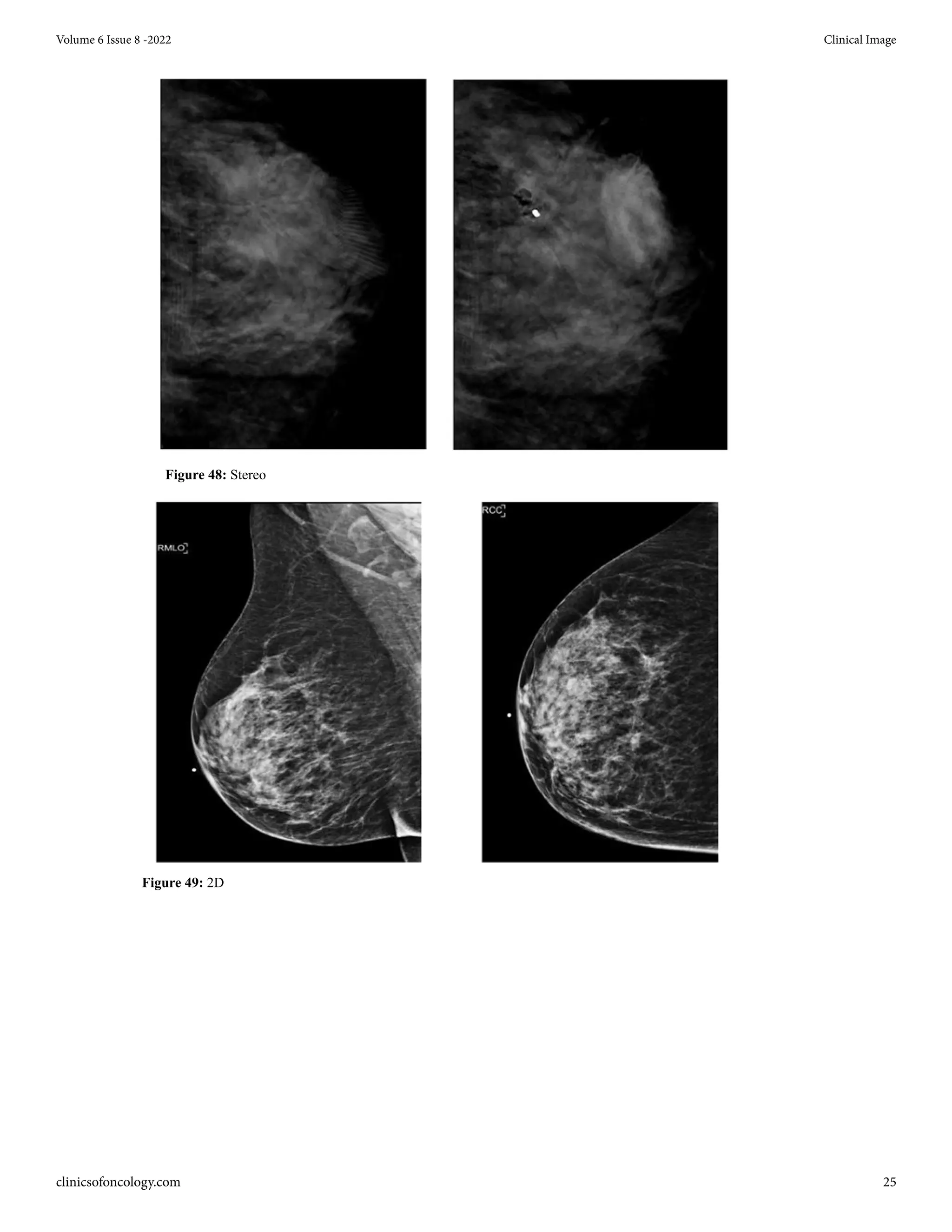 Breast Anatomy Types of Breast Tissues • Fibrous • Fibro glandular ...