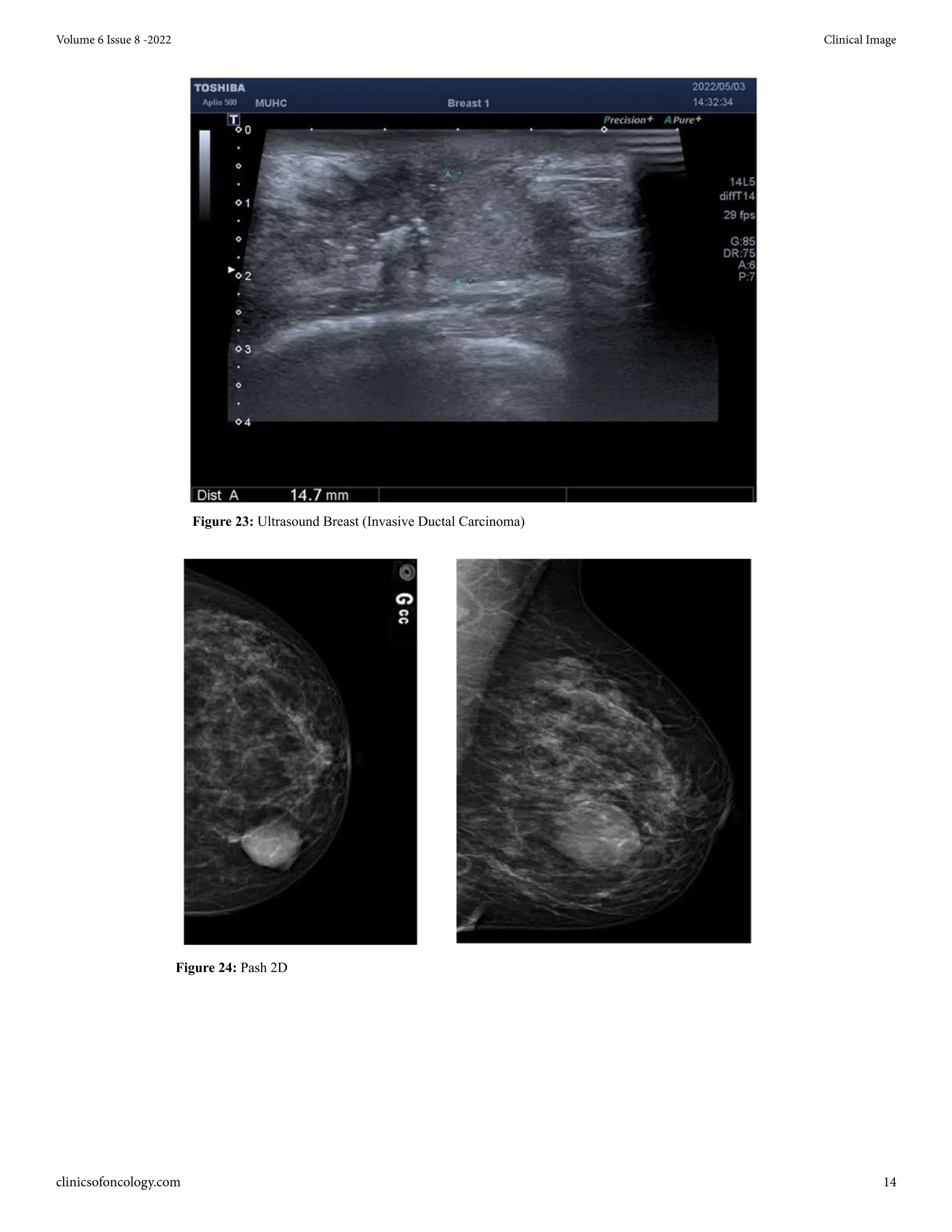 Types of Breast Tissues • Fibrous • Fibro glandular • Adipose (Fatty ...