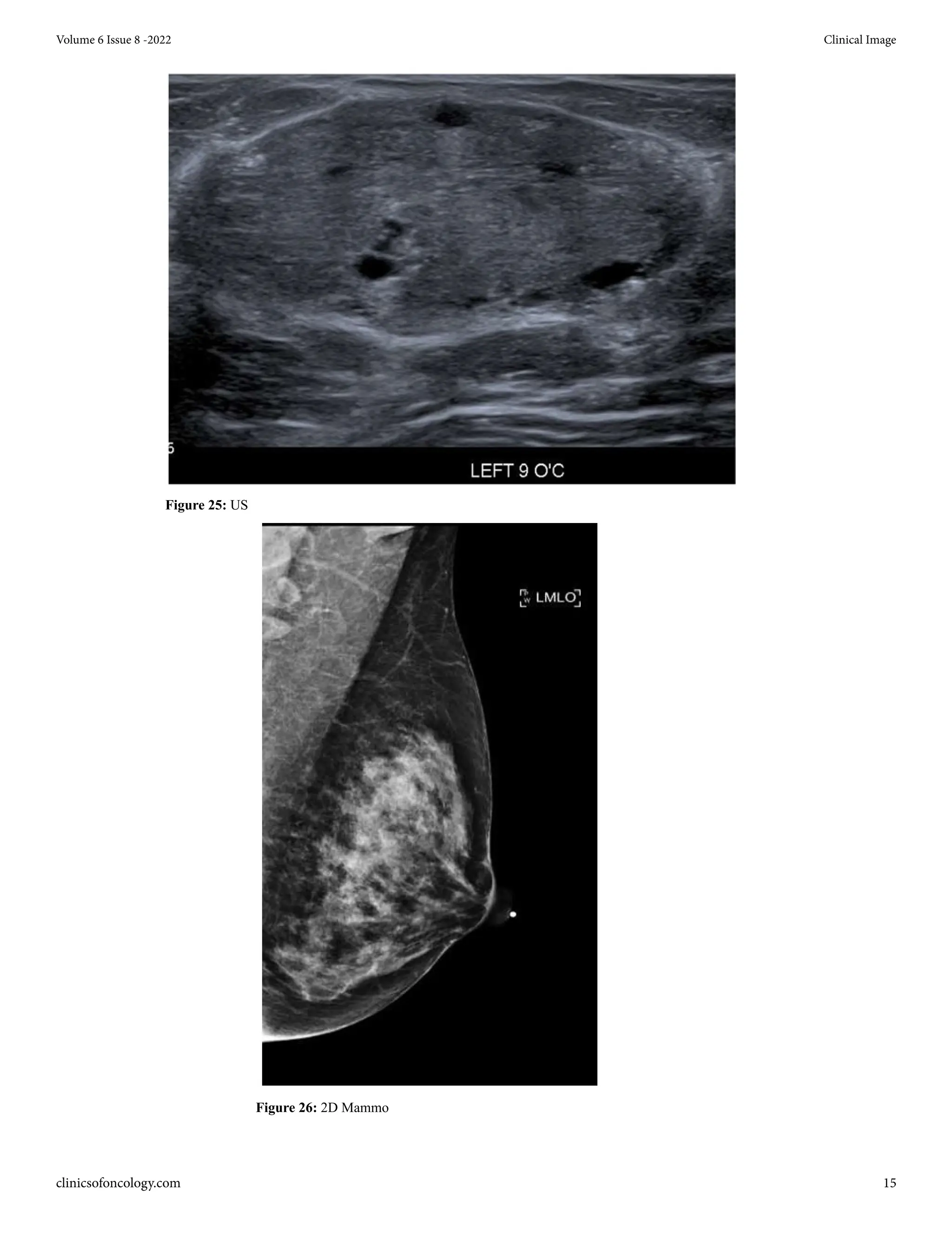 Types of Breast Tissues • Fibrous • Fibro glandular • Adipose (Fatty ...