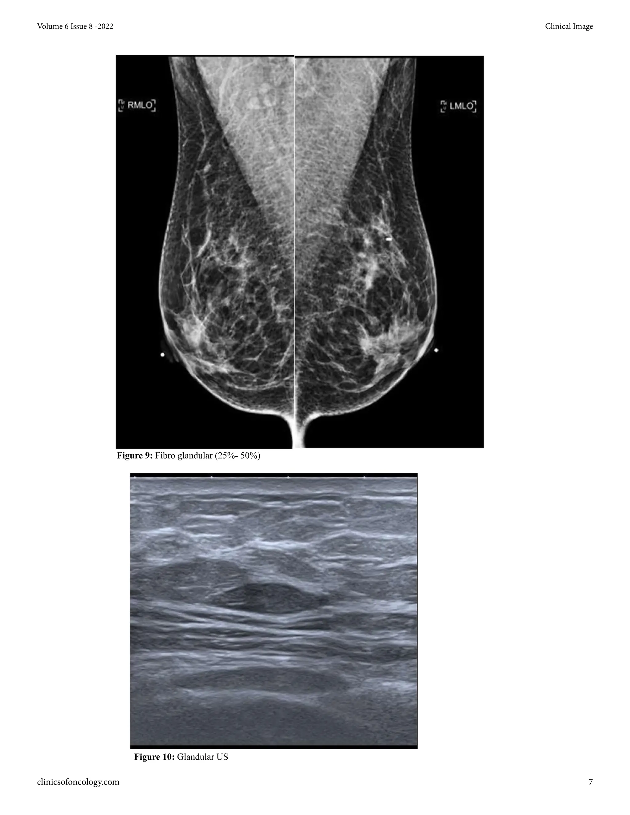 Types of Breast Tissues • Fibrous • Fibro glandular • Adipose (Fatty ...