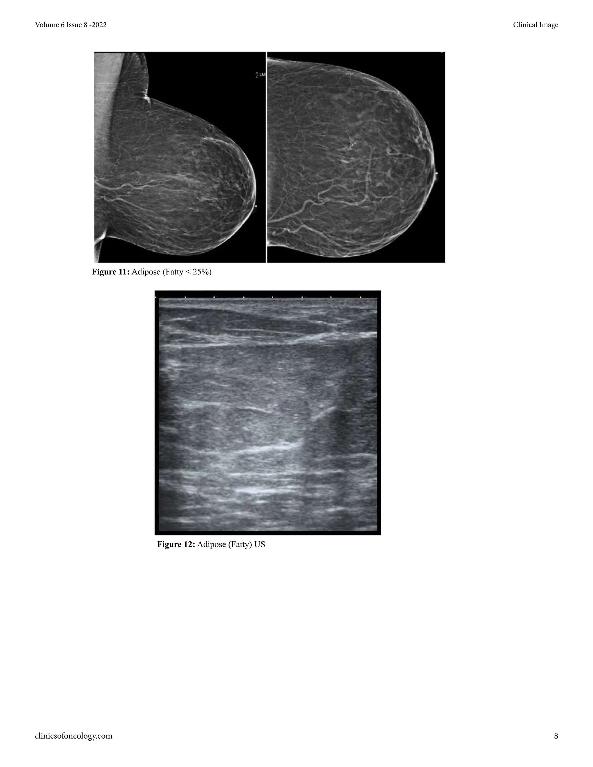 Types of Breast Tissues • Fibrous • Fibro glandular • Adipose (Fatty ...