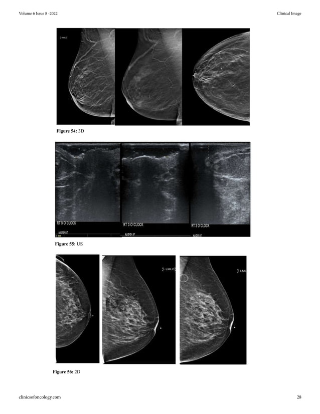 Types of Breast Tissues • Fibrous • Fibro glandular • Adipose (Fatty ...