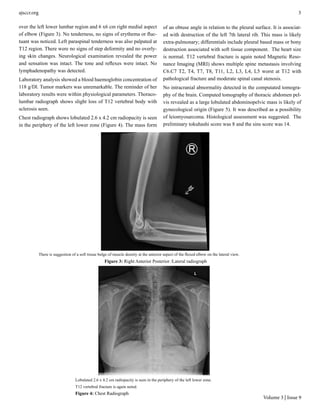 Benign Metastasizing Leiomyoma: A Case Report | PDF