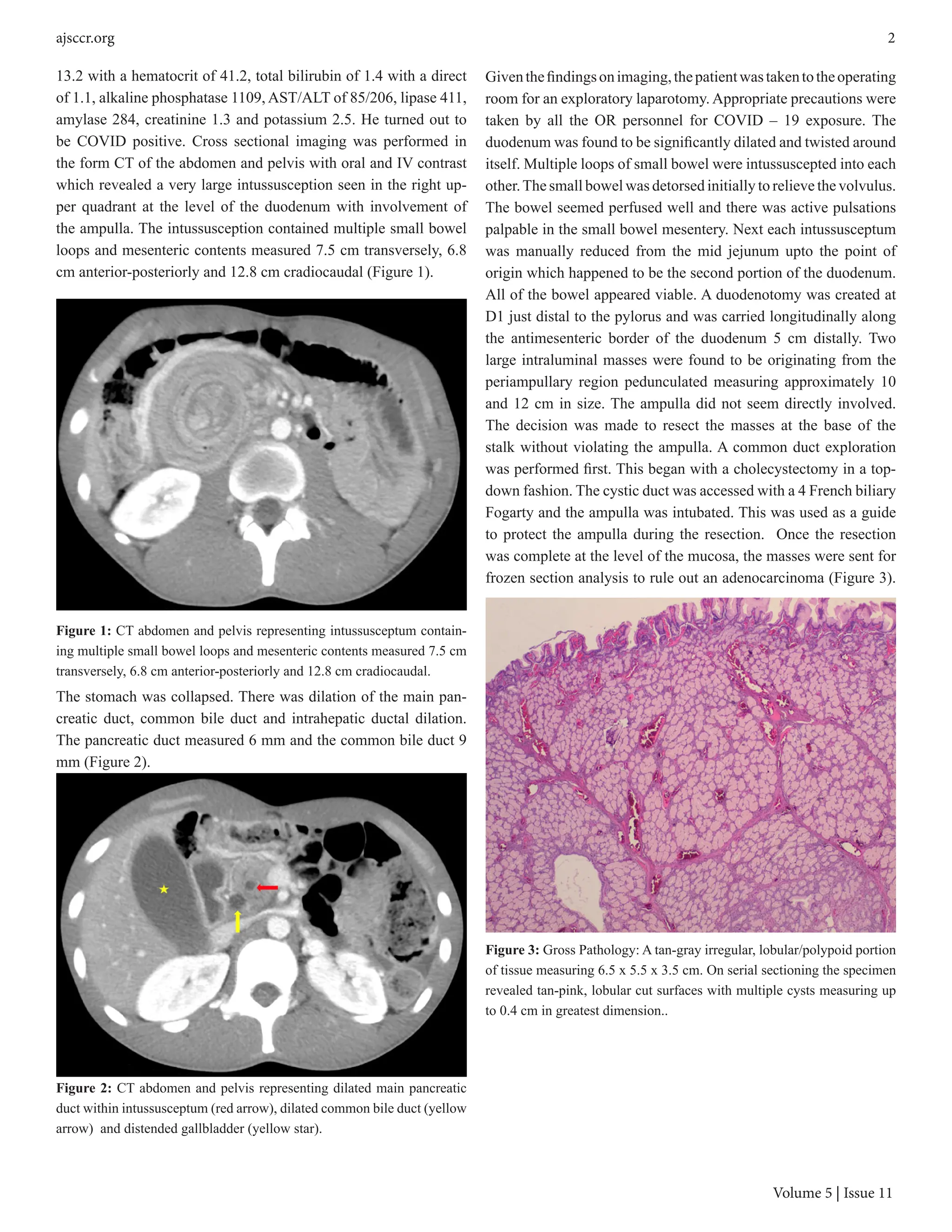 Duodenal Intussusception Secondary to Hamartomatous Polyps of the ...