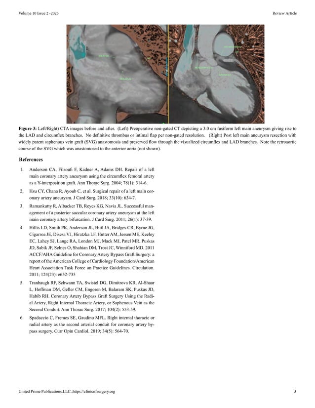 Pulmonary Artery Division for Total Excision and Bypass of Left Main ...