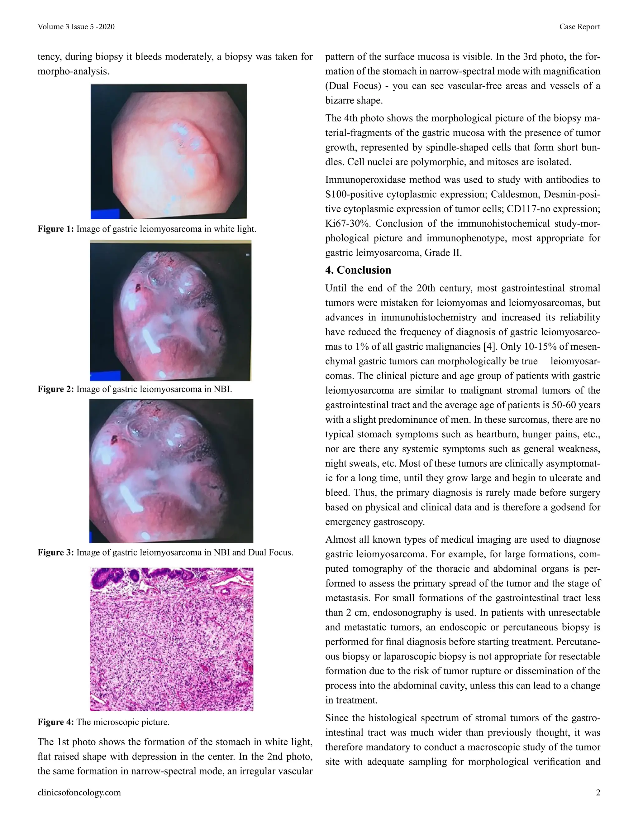 Leiomyosarcoma of Stomach | PDF