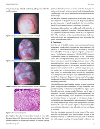 Leiomyosarcoma of Stomach | PDF