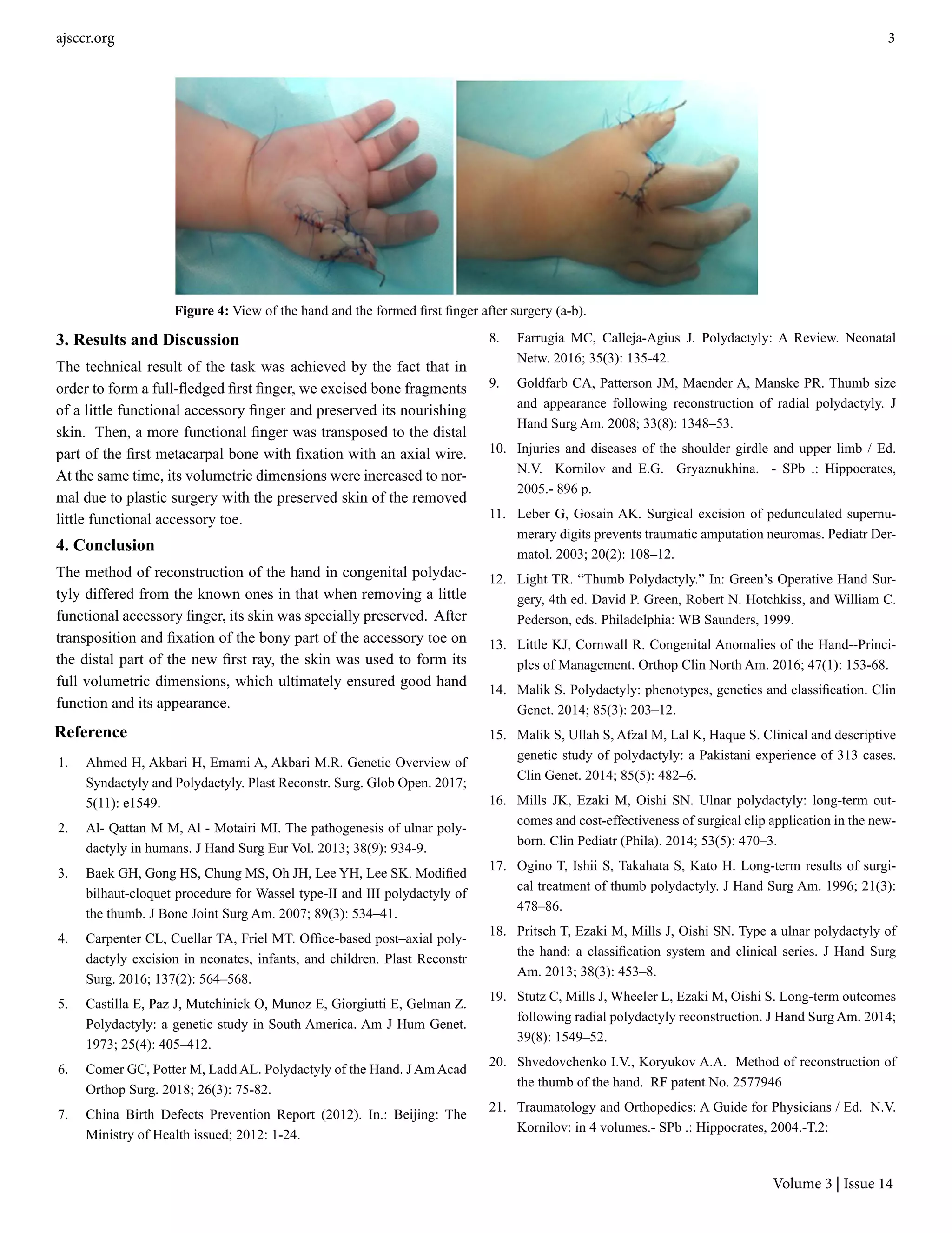 Reconstruction of The Hand in Congenital Polydactyly | PDF