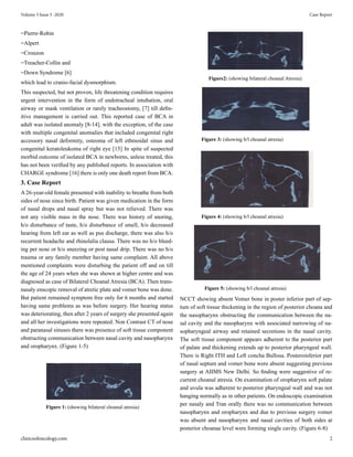 Is Bilateral Choanal Atresia a Real Emergency? One Case Report | PDF