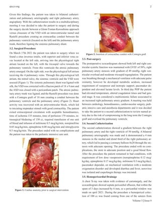 Total Situs Inversus and D- Transposition of Great Arteries Managed in ...
