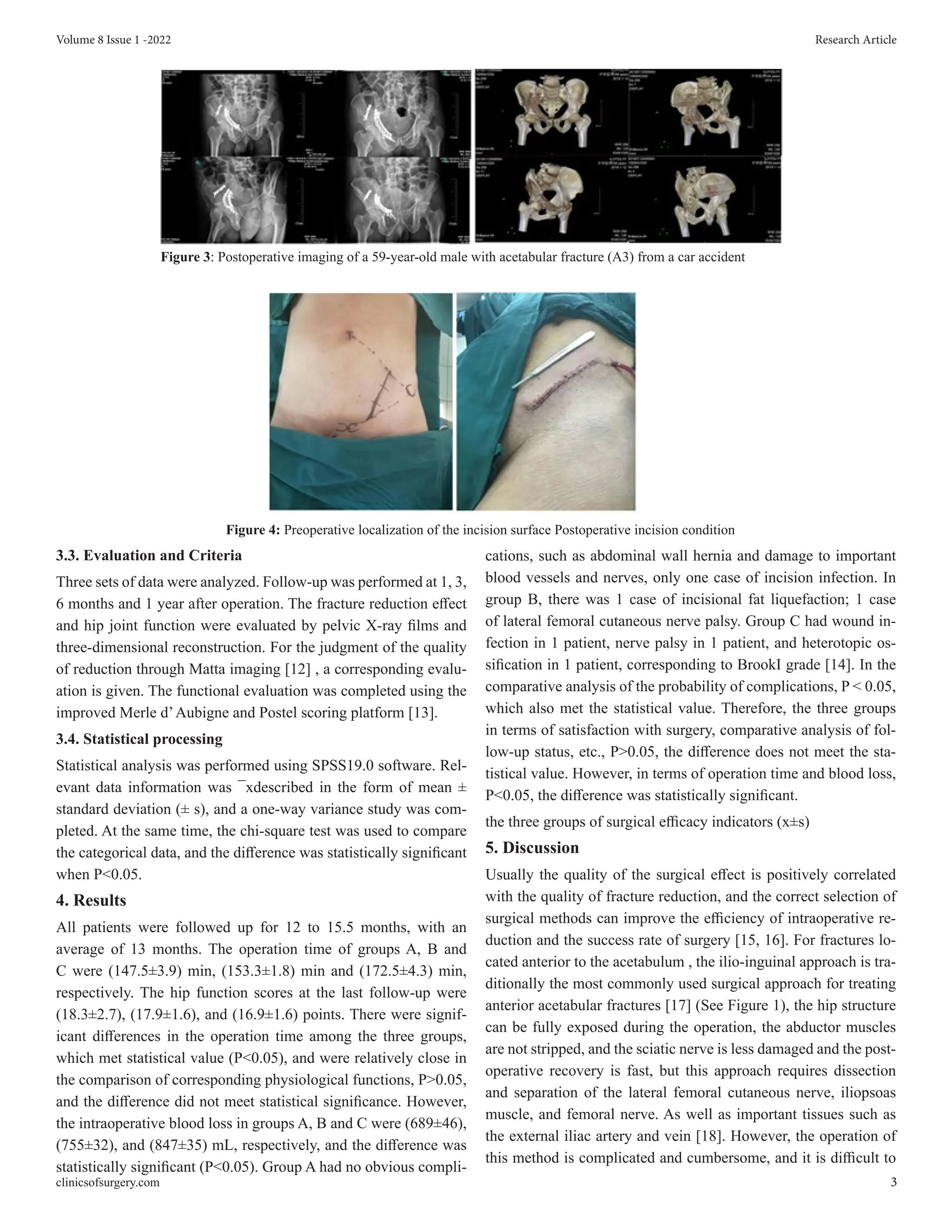 Comparison of Clinical Efficacy of Surgical Approaches for Acetabular ...