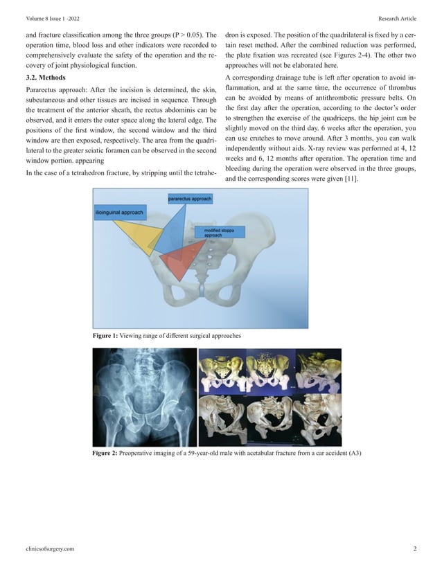 Comparison of Clinical Efficacy of Surgical Approaches for Acetabular ...
