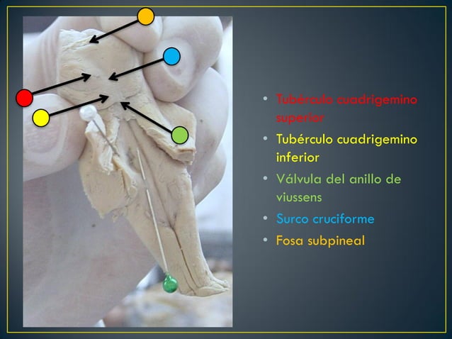 Imágenes neuroanatomícas del tronco encefálico | PPT