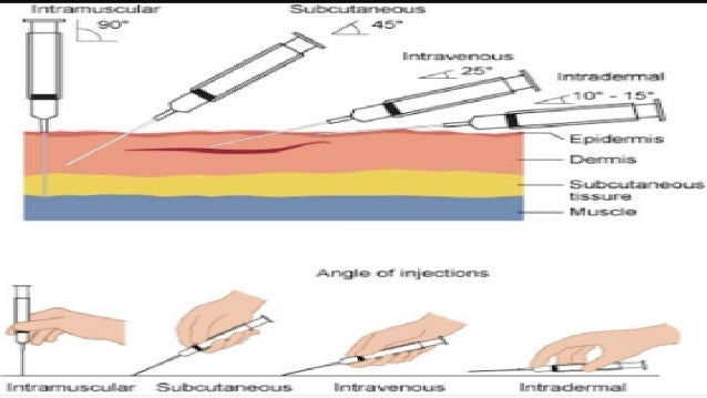 Intramuscular injection