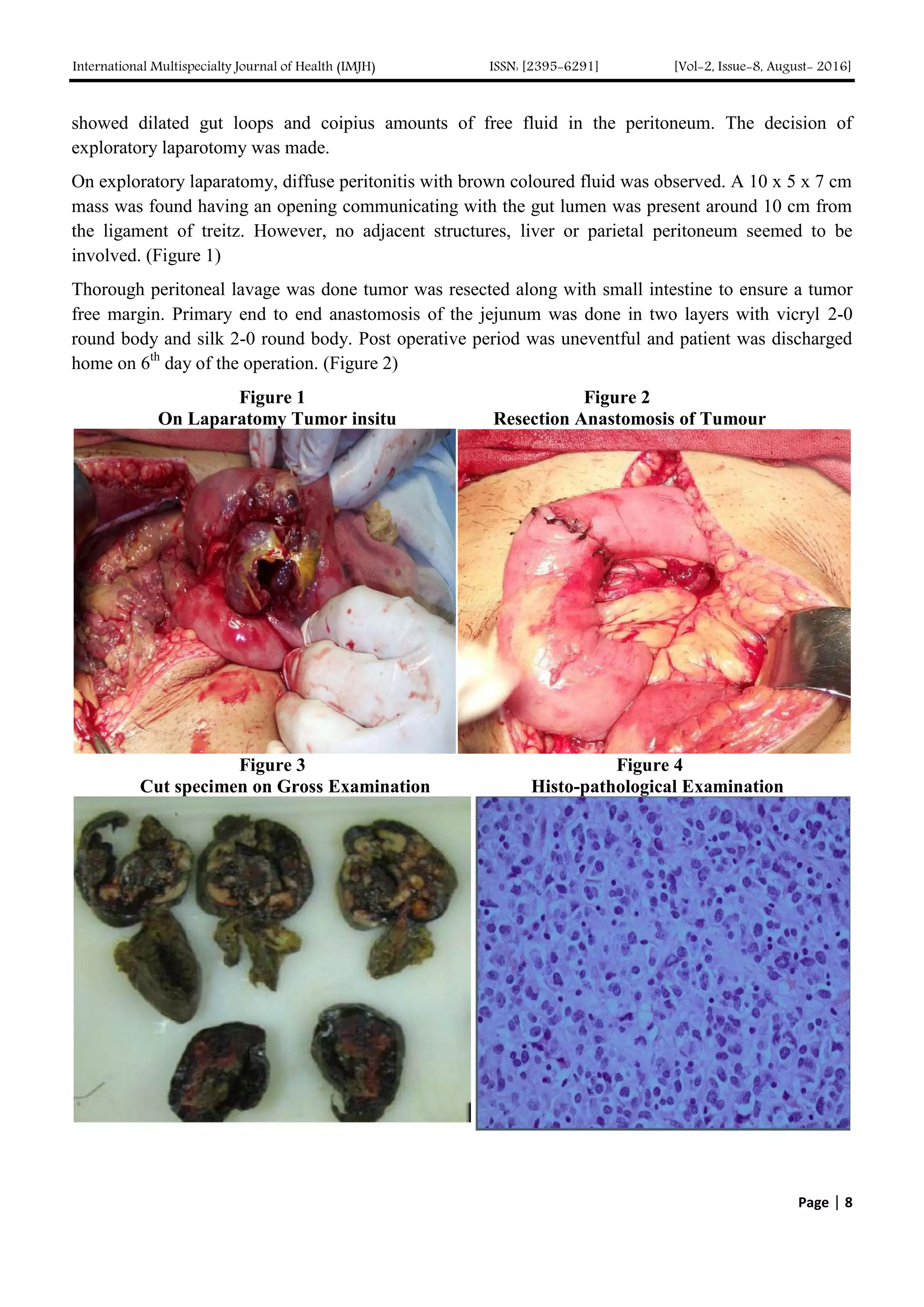 Perforated Jejunal Gastrointestinal Stromal Tumor(GIST) Presenting as ...