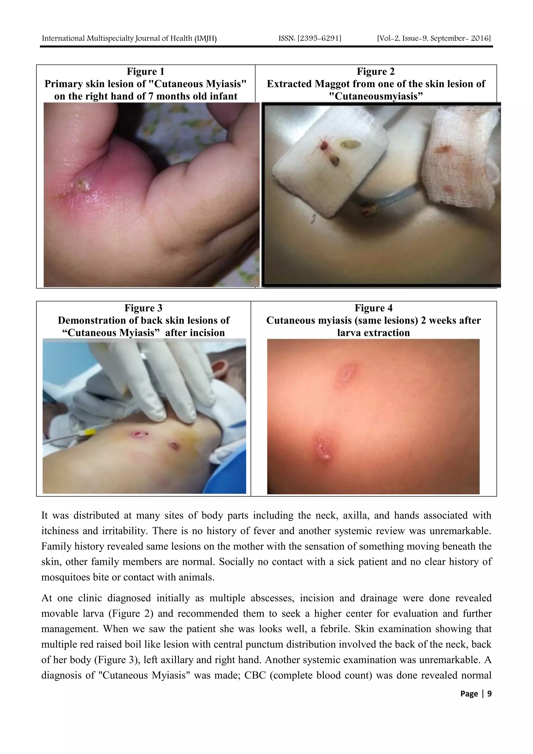 Cutaneous Myiasis in Saudi Infant: A Rare Case Report | PDF