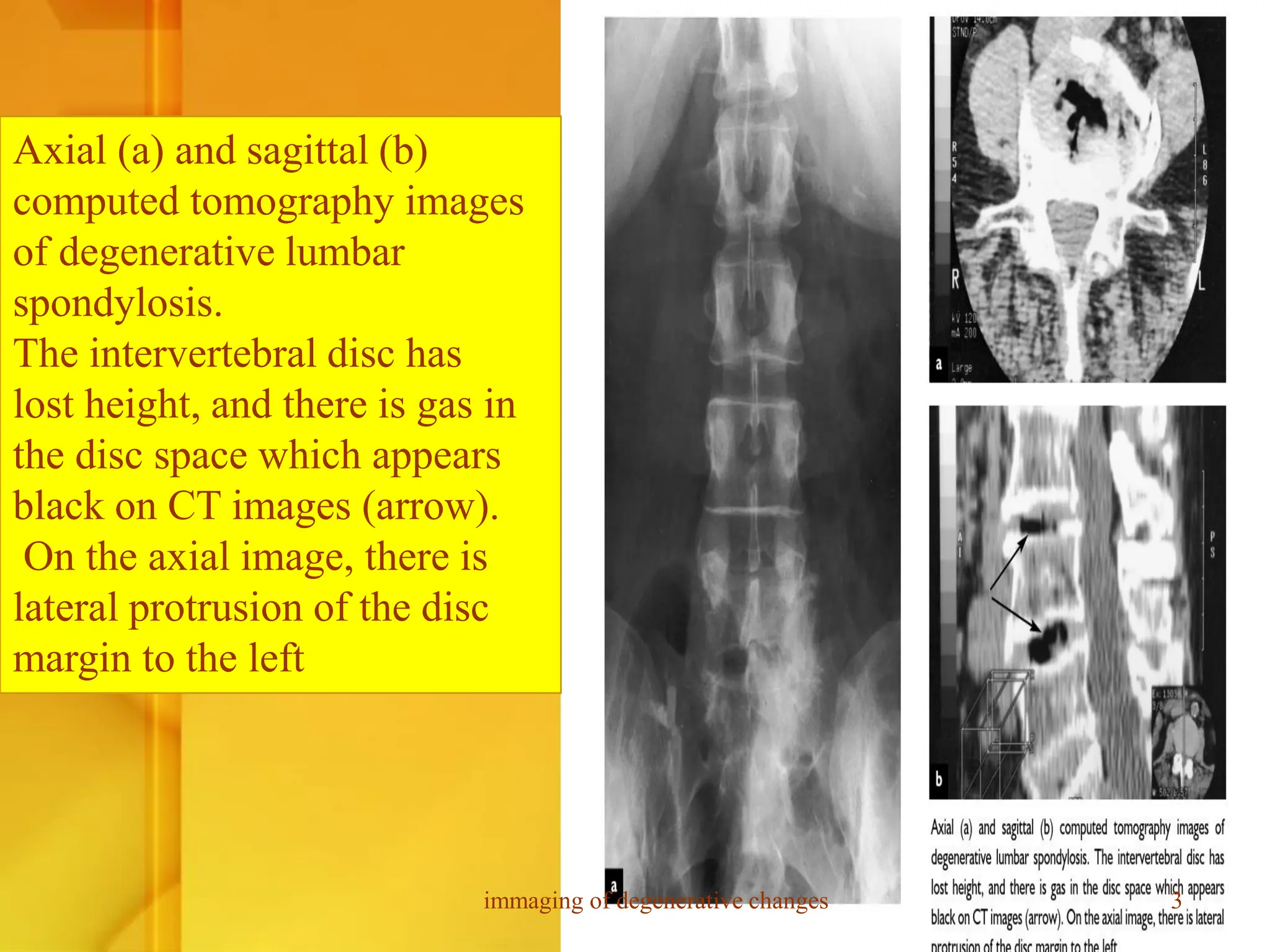 imaging of spinal degeneration | PDF