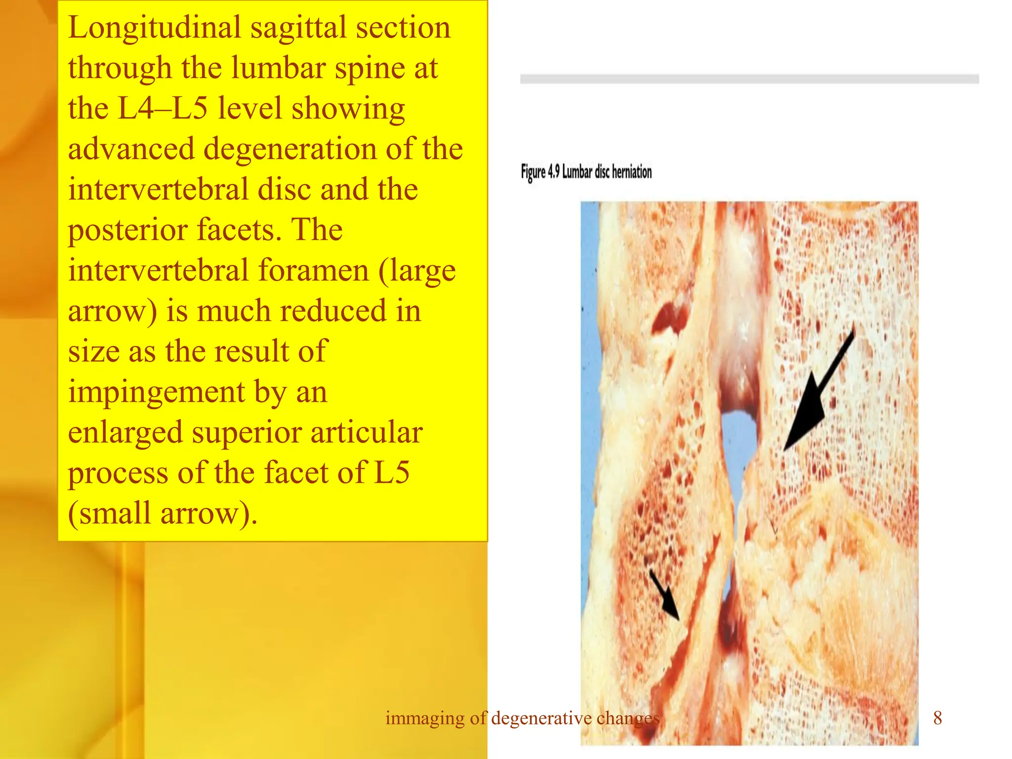 imaging of spinal degeneration | PDF