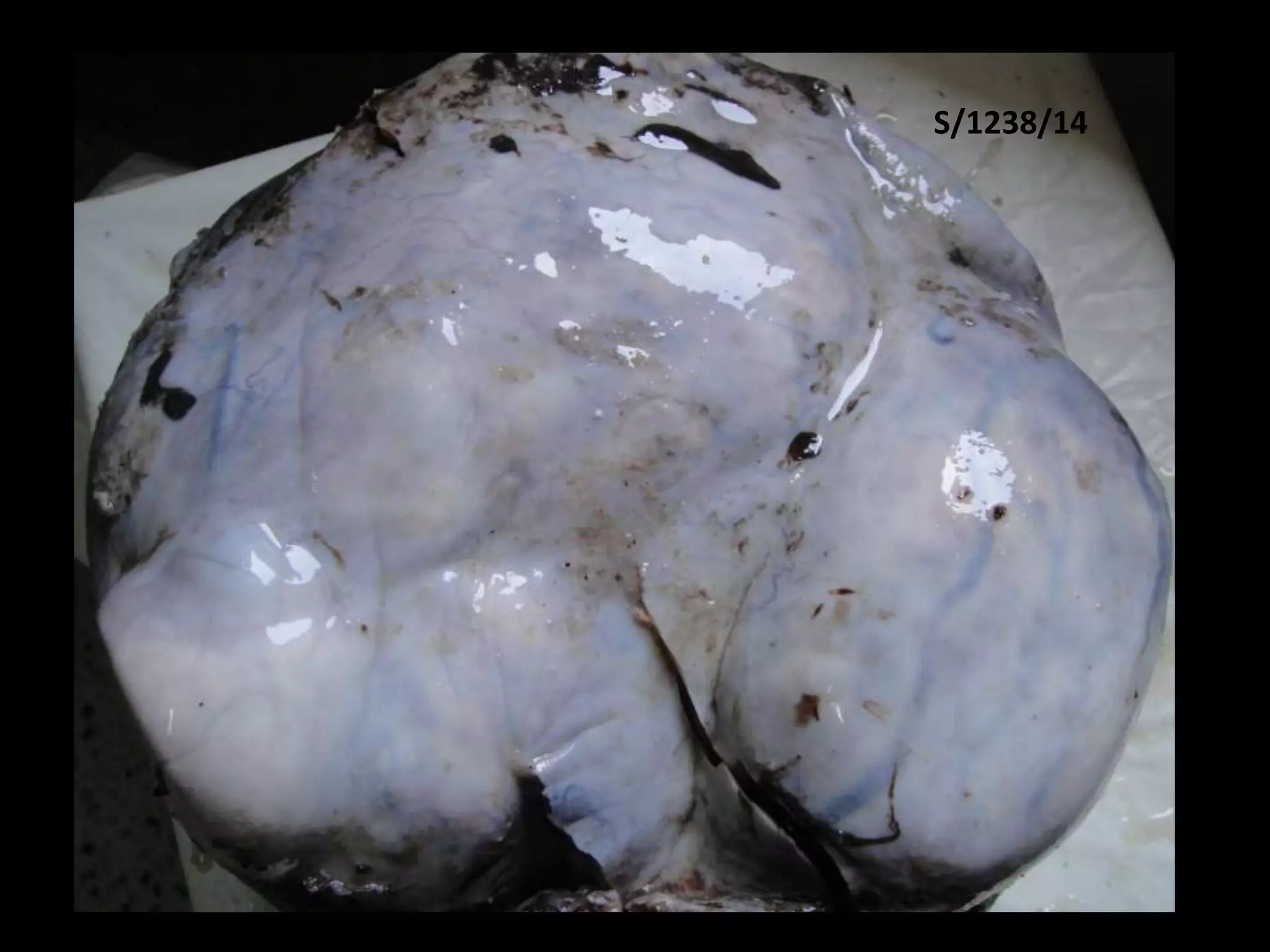 Immature teratoma | PPTX
