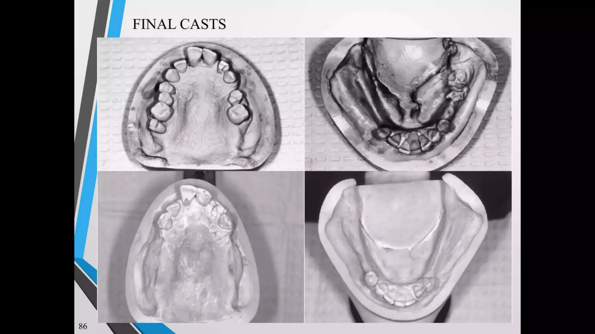 Immediate complete denture 05032023.pptx