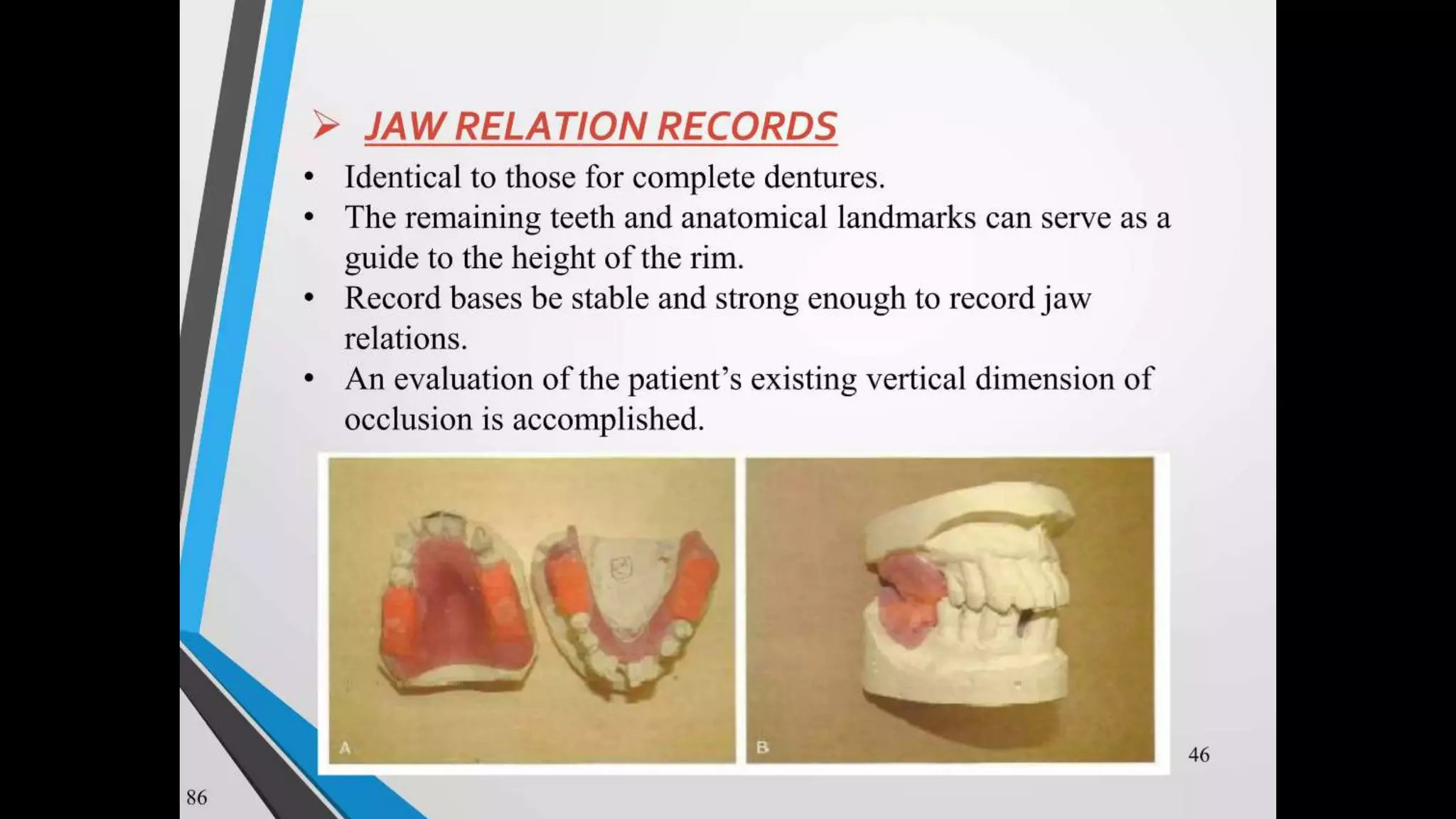 Immediate complete denture 05032023.pptx