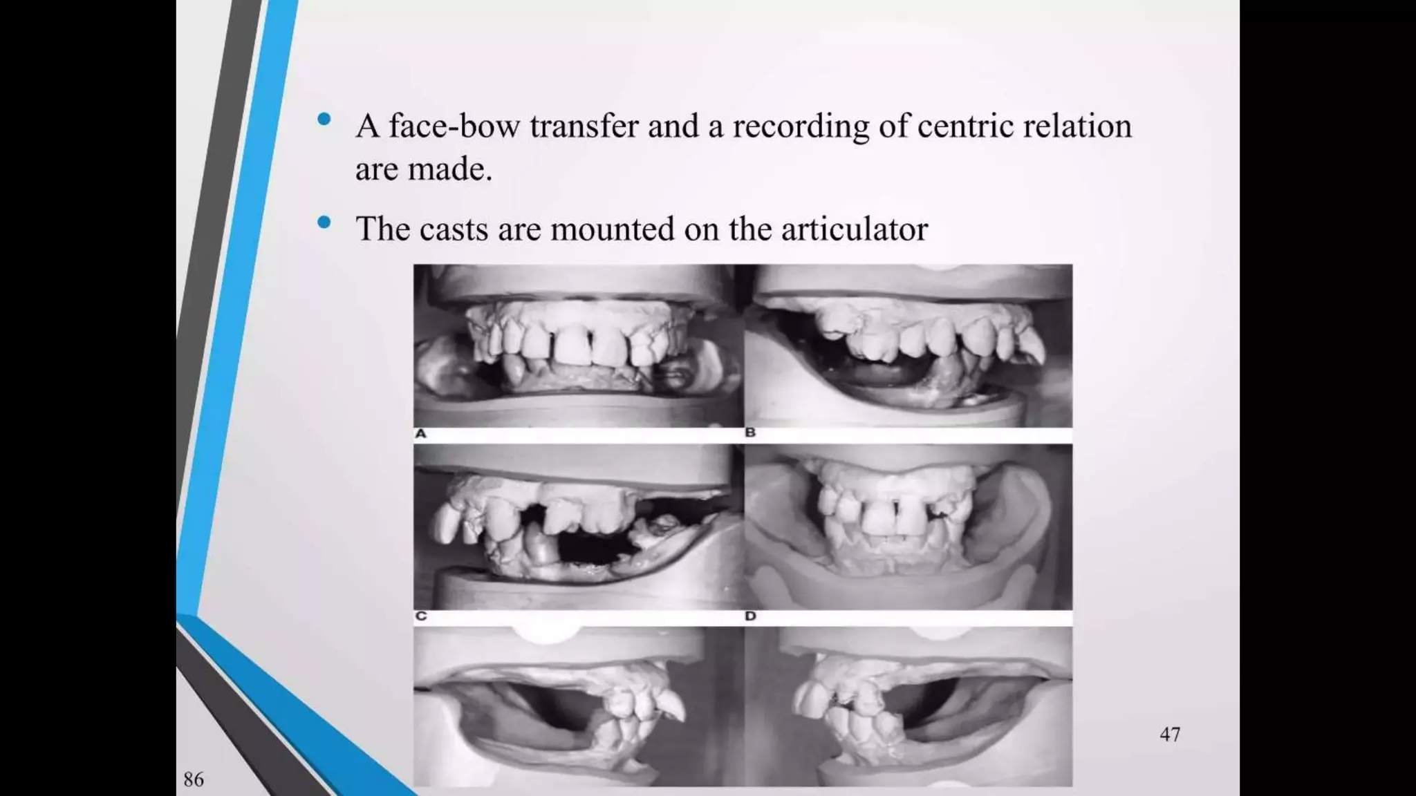 Immediate complete denture 05032023.pptx