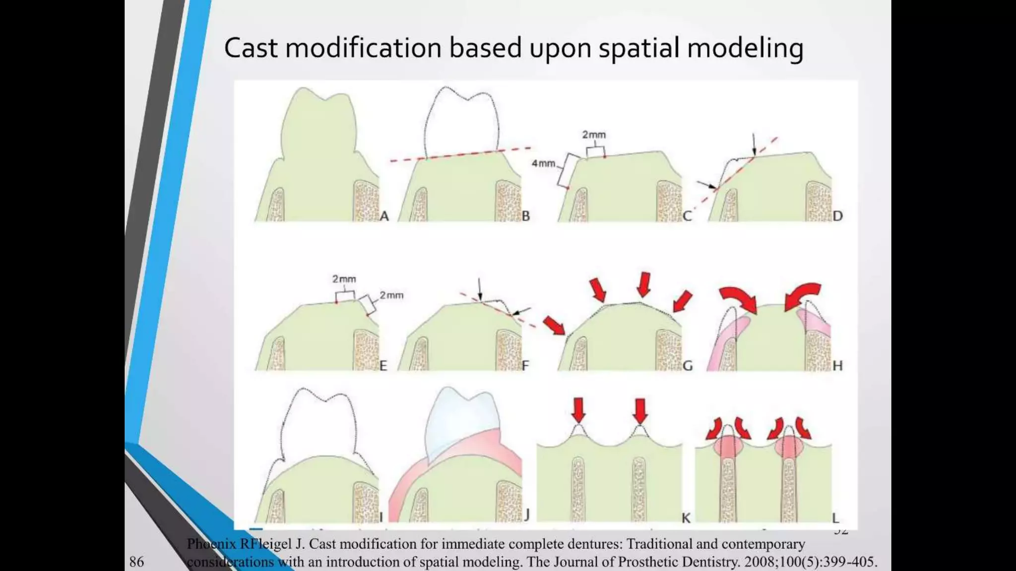 Immediate complete denture 05032023.pptx