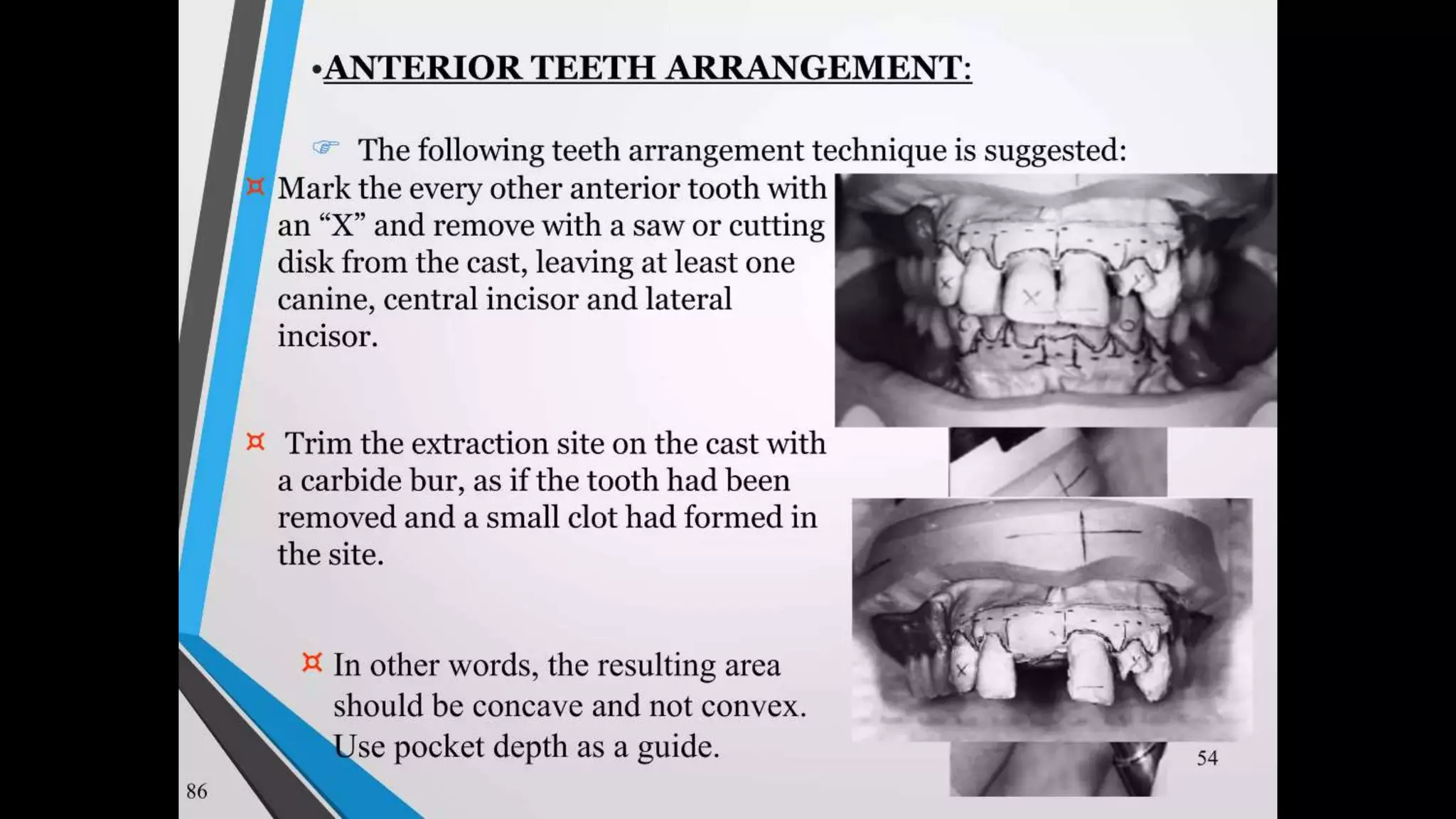 Immediate complete denture 05032023.pptx