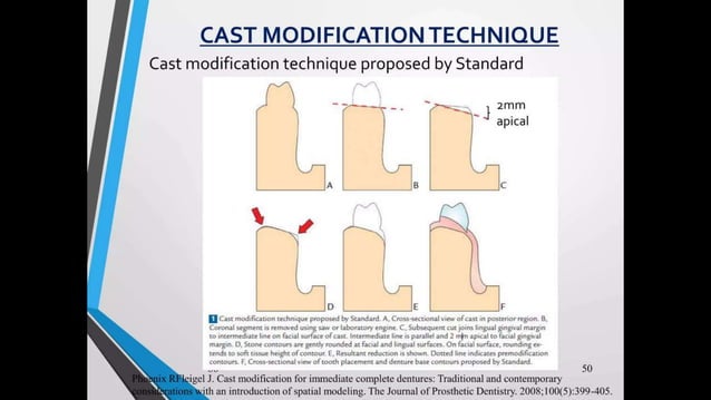 Immediate complete denture 05032023.pptx