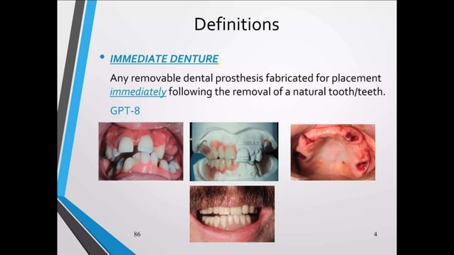Immediate complete denture 05032023.pptx