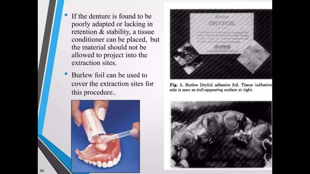 Immediate complete denture 05032023.pptx