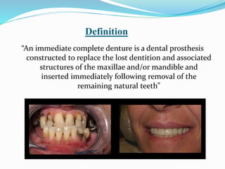 Immediate Complete Dentures | PPTX