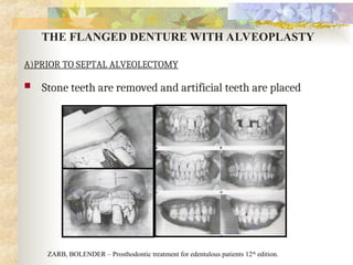 MANAGEMENT OF EDENTULOUS PATIENTS WITH IMMEDIATE COMPLETE DENTURES | PPT