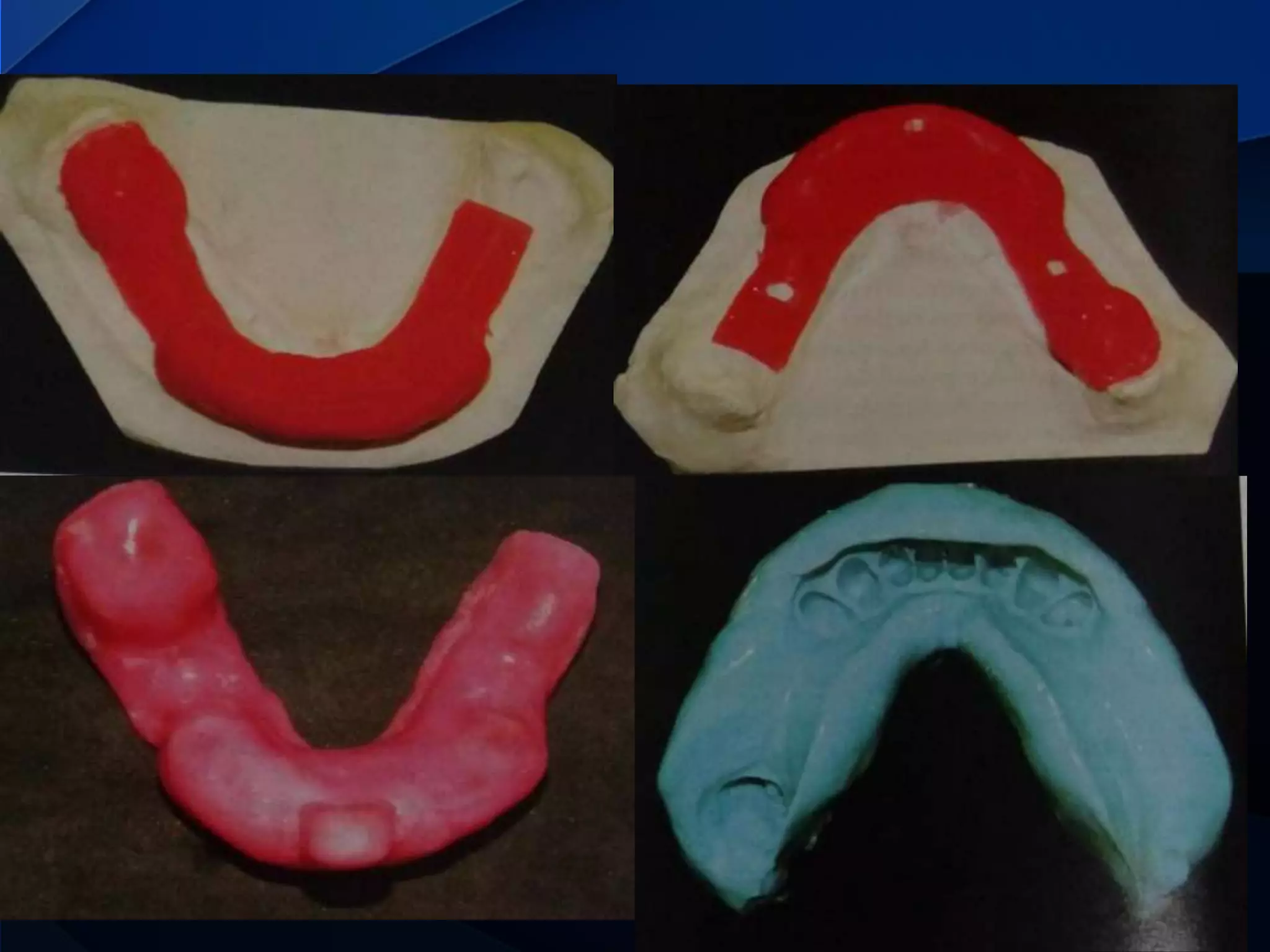 Immediate complete dentures | PPTX