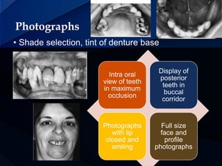 Immediate complete dentures | PPTX