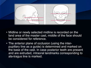 Immediate complete dentures | PPTX