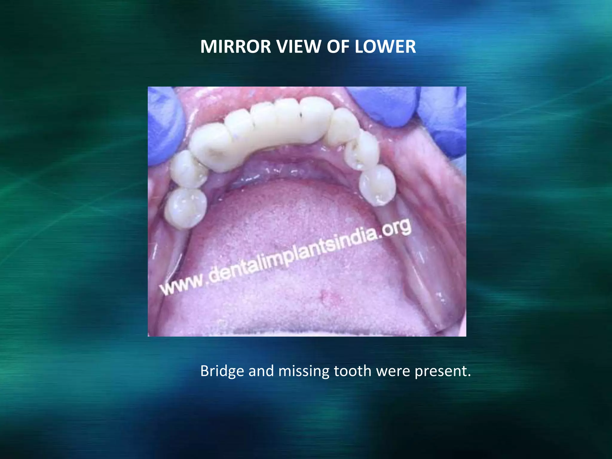 Immediate dental implant without bone grafts in chennai | PPT | Free ...