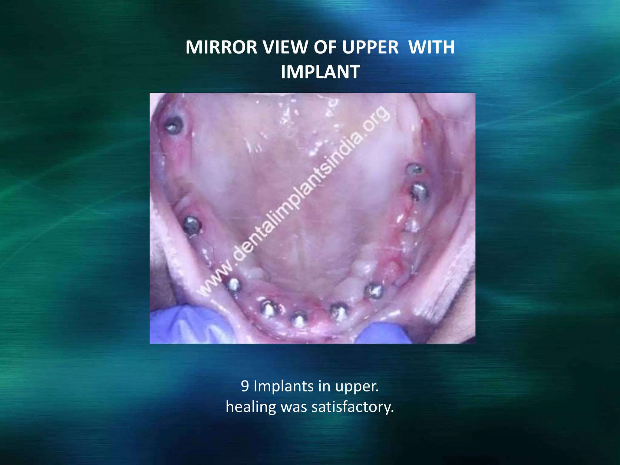 Immediate dental implant without bone grafts in chennai | PPT | Free ...