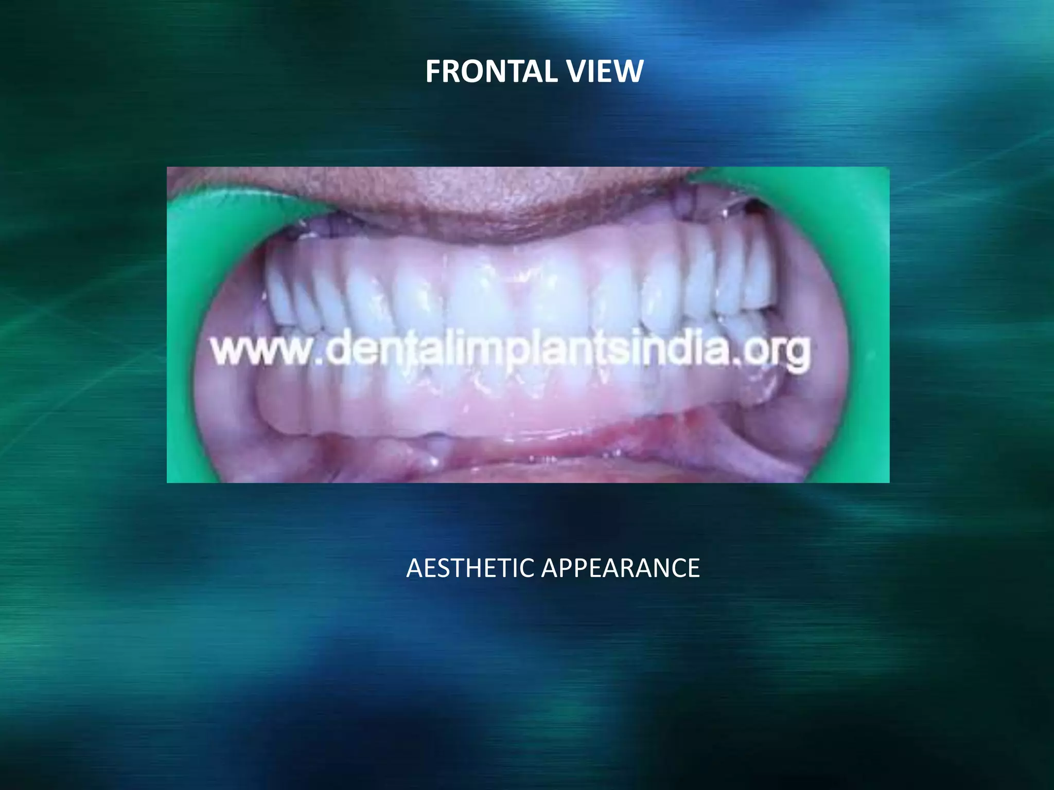 Immediate dental implant without bone grafts in chennai | PPT | Free ...