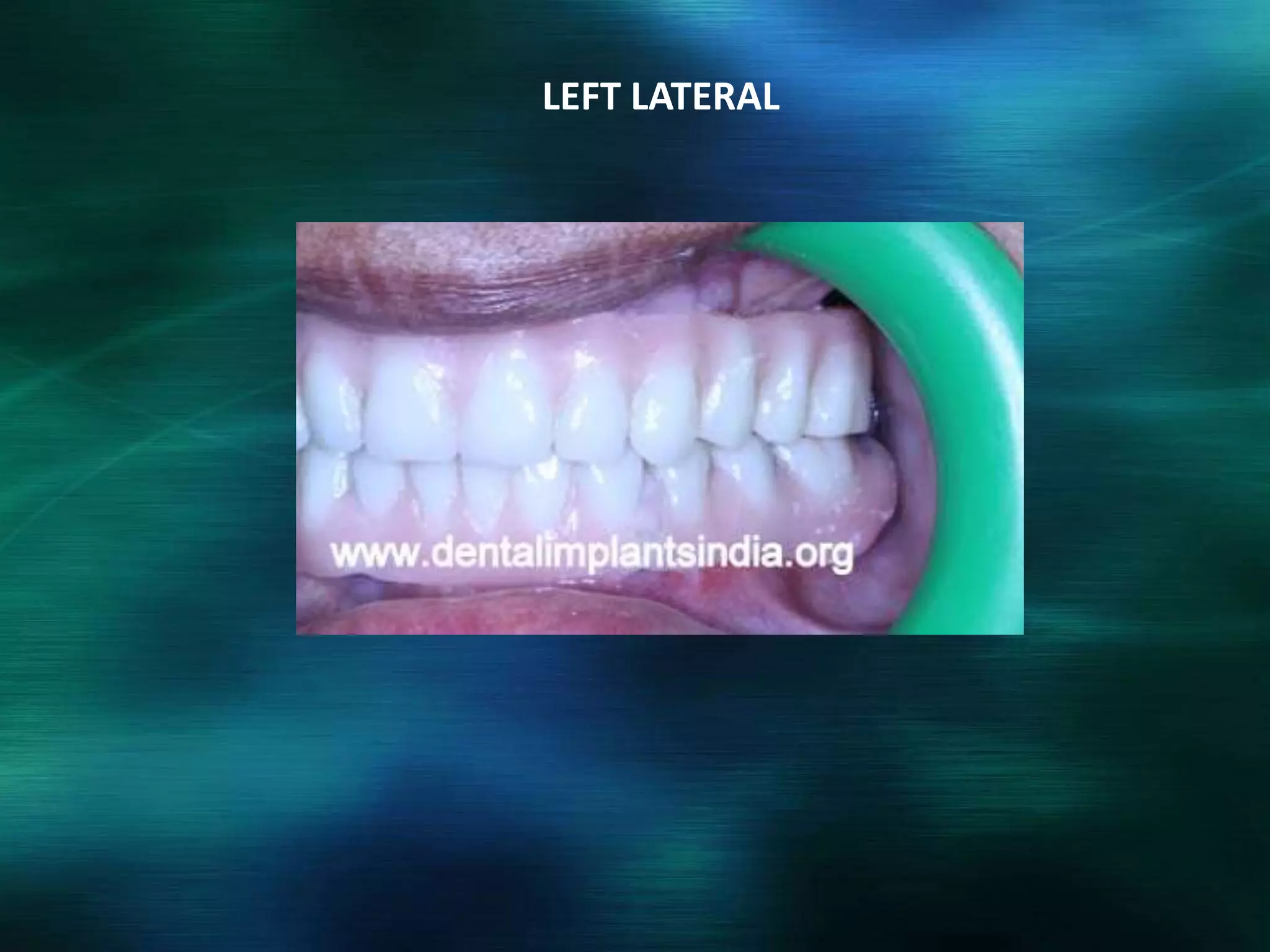 Immediate dental implant without bone grafts in chennai | PPT | Free ...