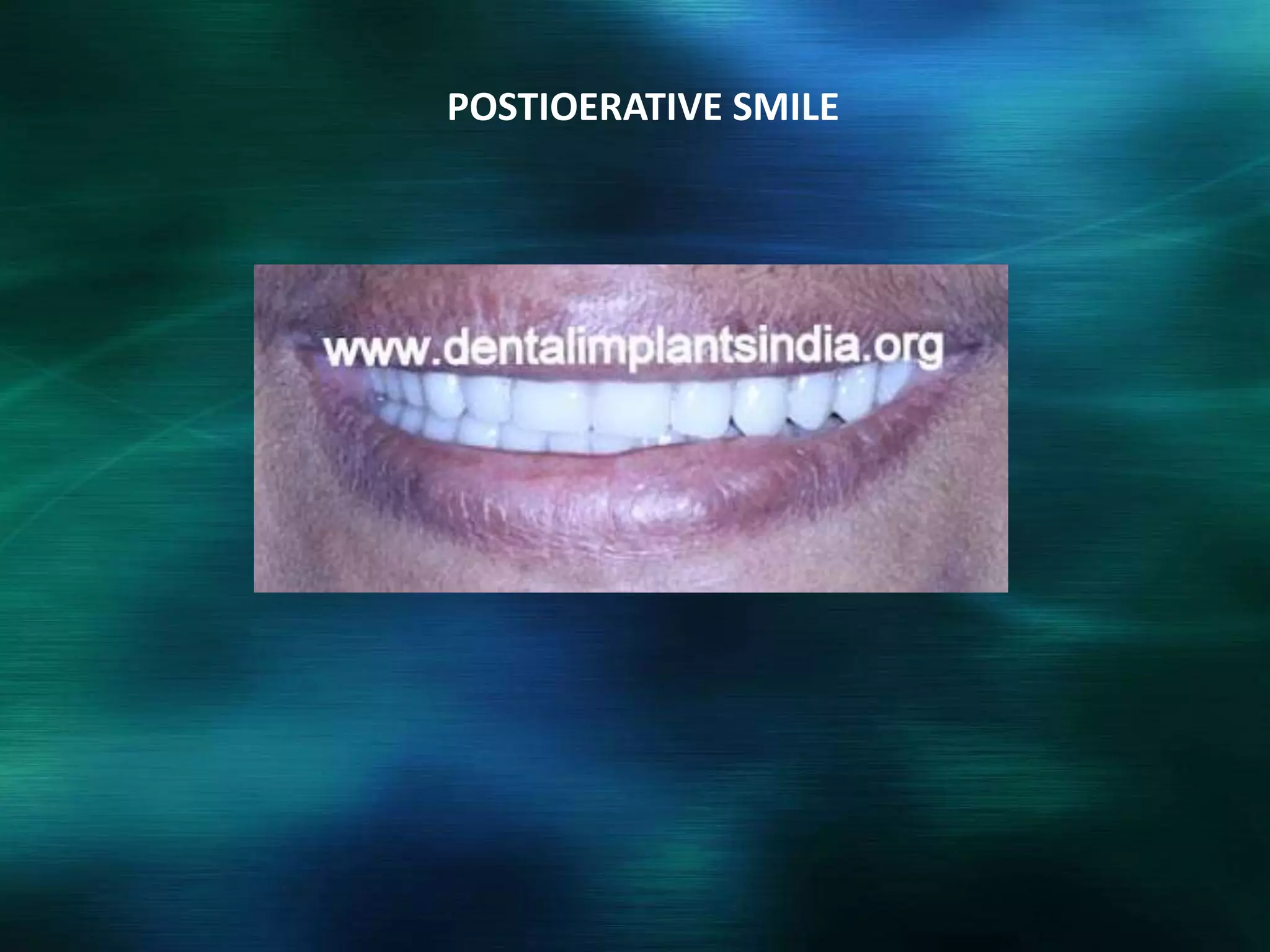 Immediate dental implant without bone grafts in chennai | PPT | Free ...