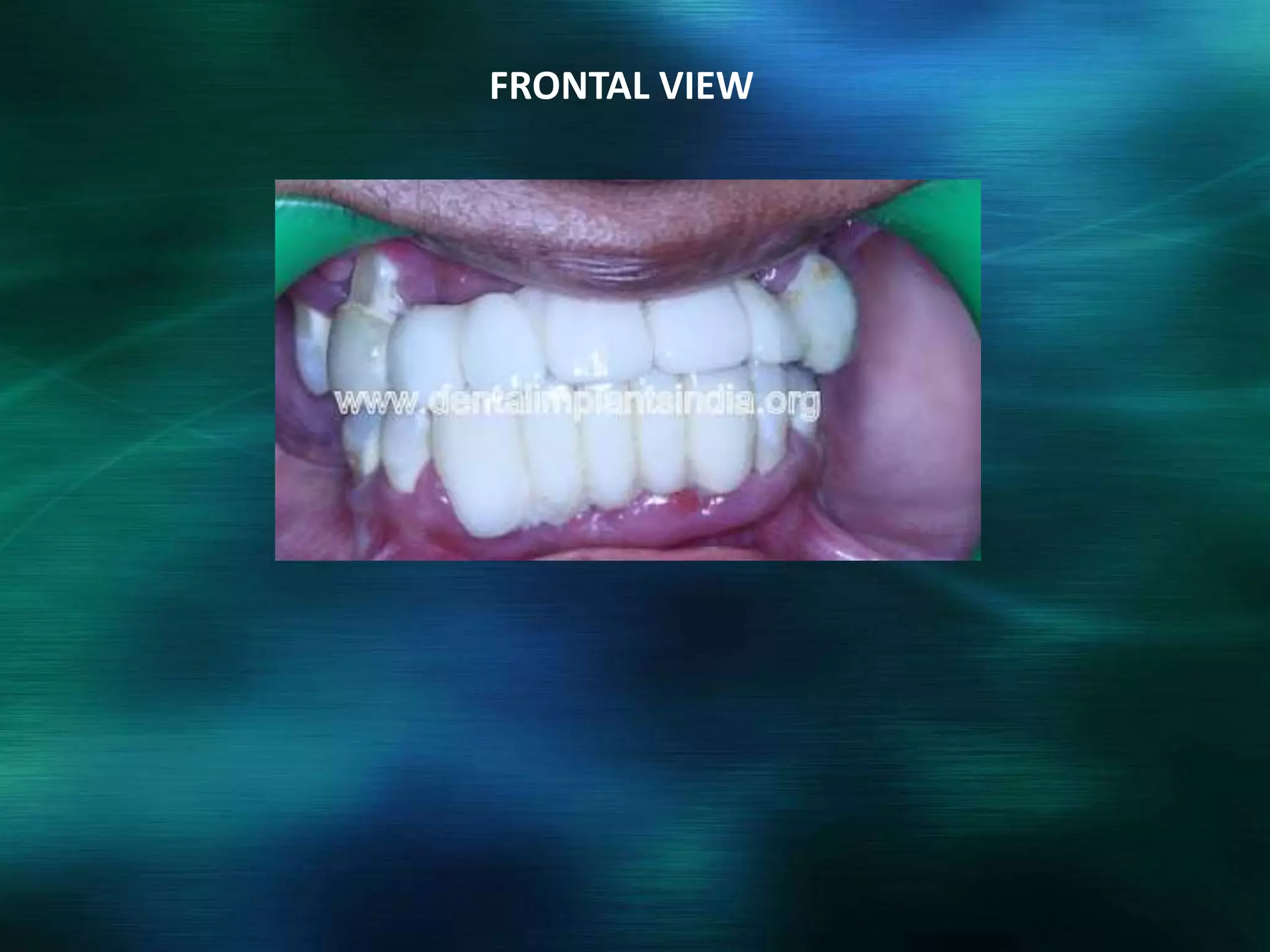 Immediate dental implant without bone grafts in chennai | PPT | Free ...