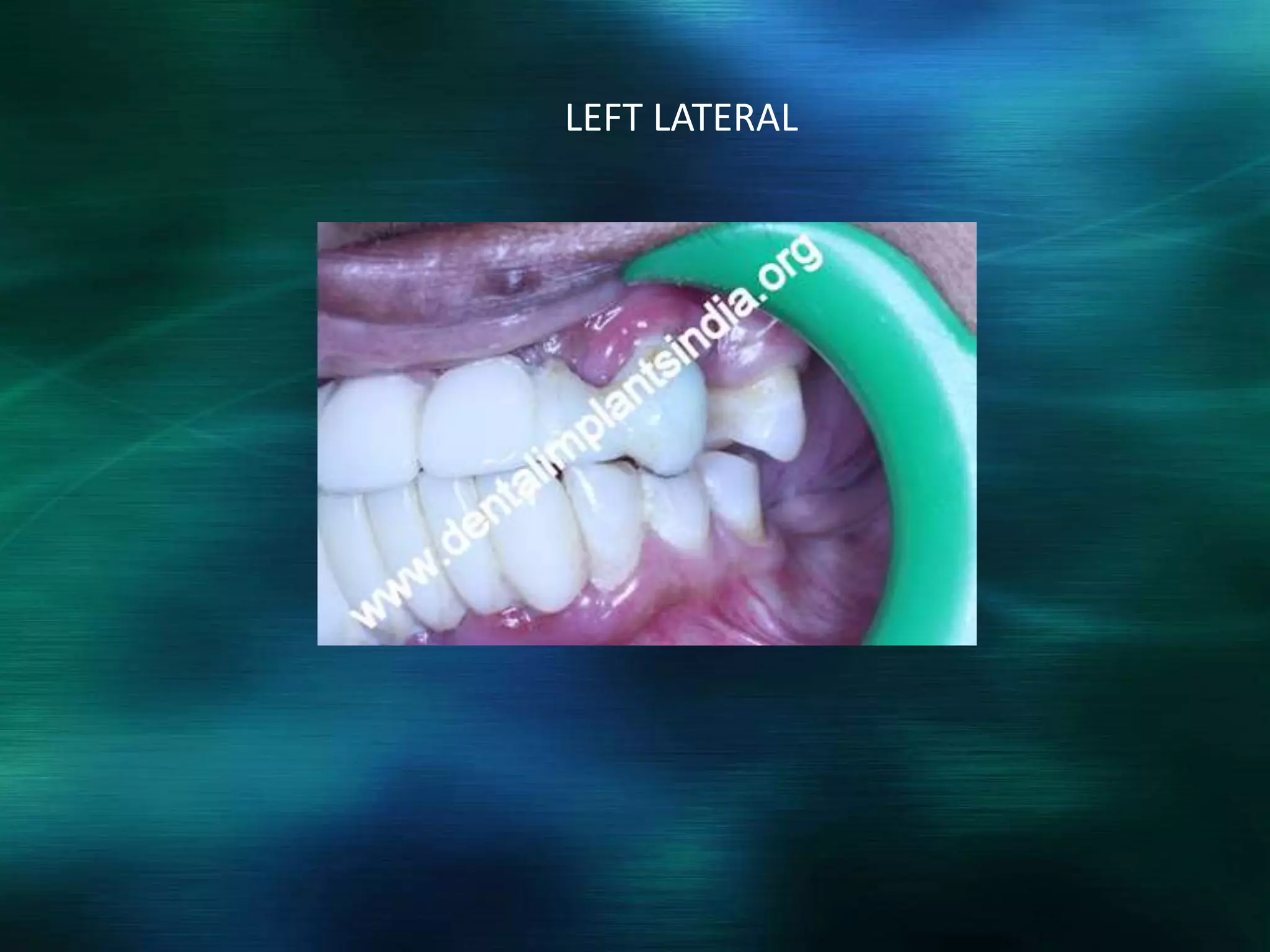 Immediate dental implant without bone grafts in chennai | PPT | Free ...