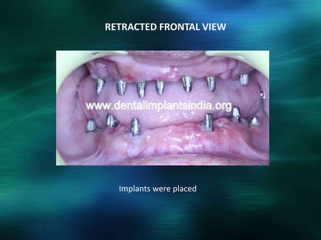 Immediate dental implant without bone grafts in chennai | PPT | Free ...