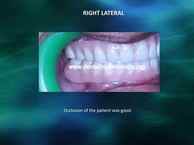 Immediate dental implant without bone grafts in chennai | PPT | Free ...