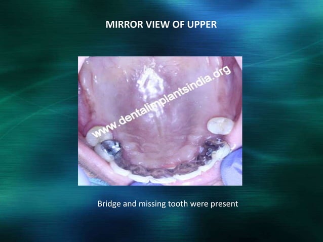 Immediate dental implant without bone grafts in chennai | PPT | Free ...