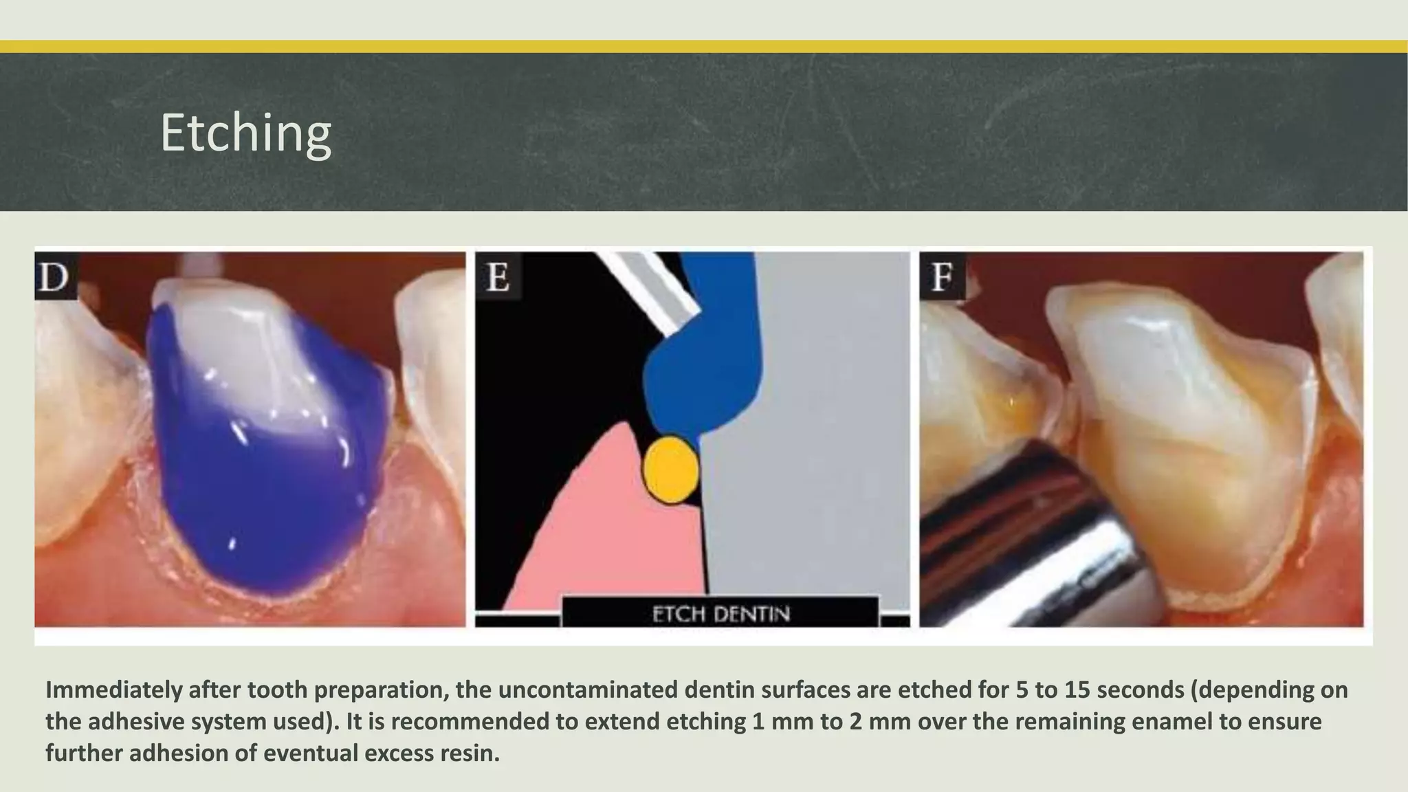 ImmediateDentinSealing.pptx