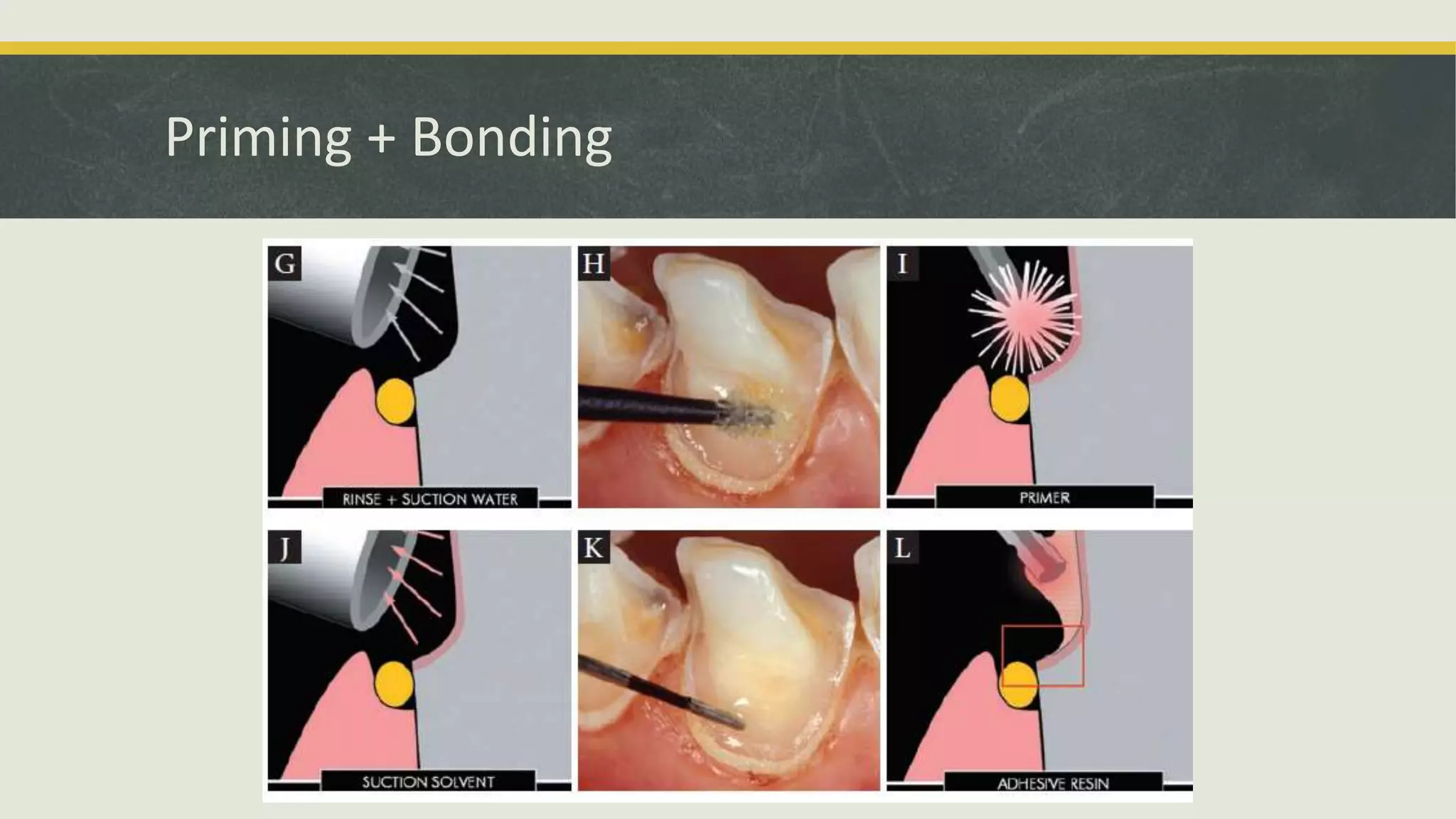 ImmediateDentinSealing.pptx