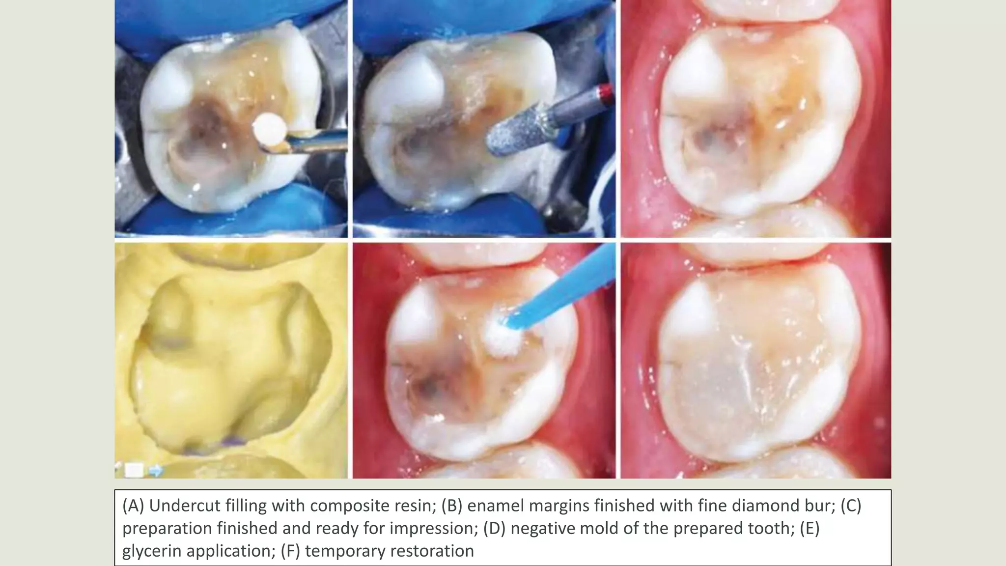 ImmediateDentinSealing.pptx