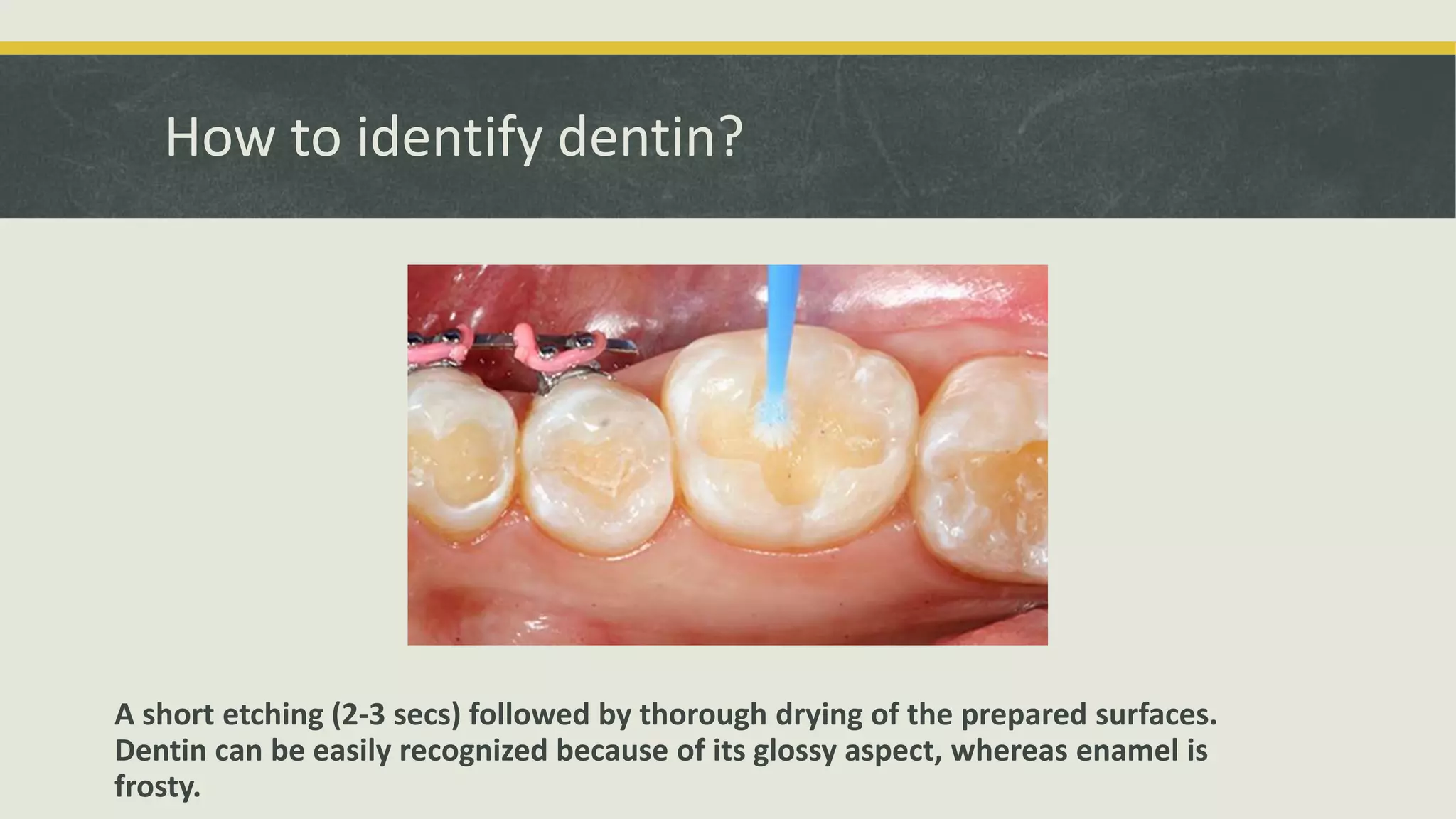 ImmediateDentinSealing.pptx